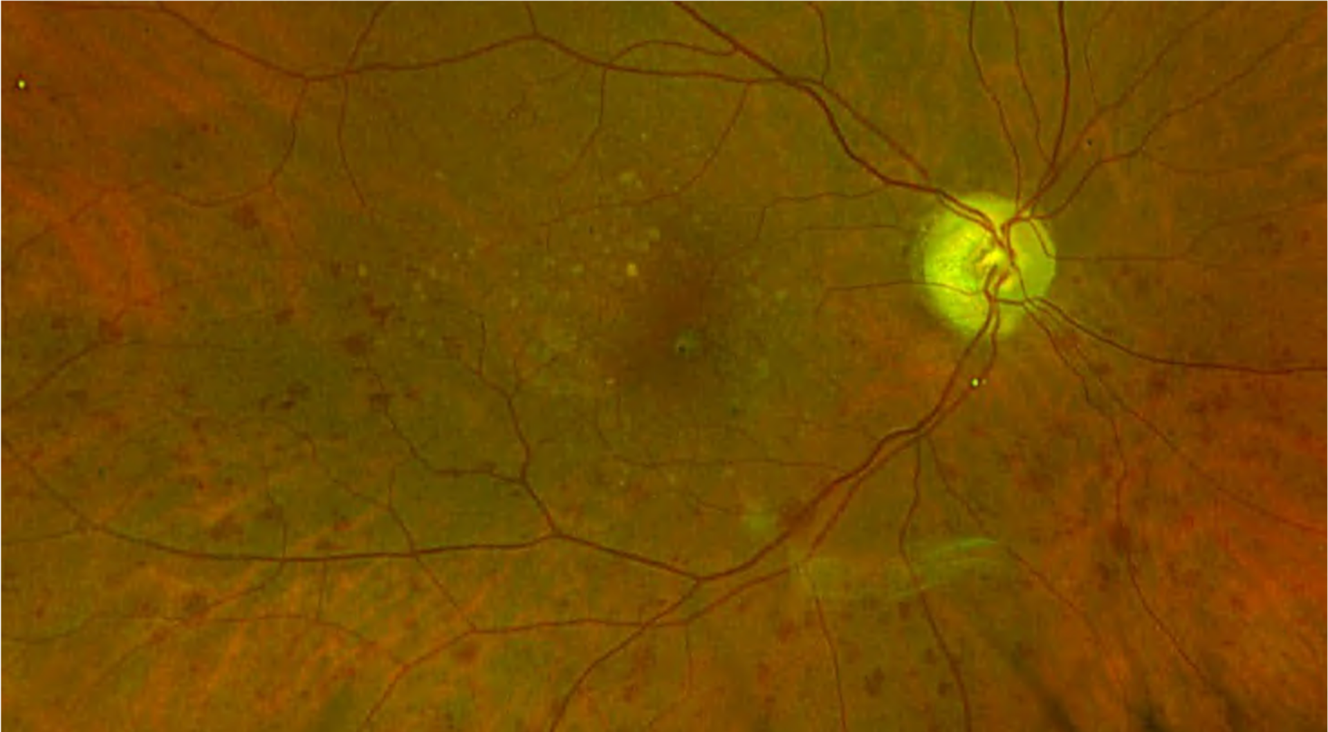 Retinal vein occlusion | Viewpoint