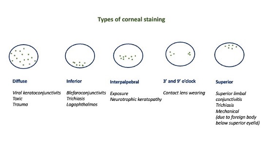 Dry eye disease | Viewpoint
