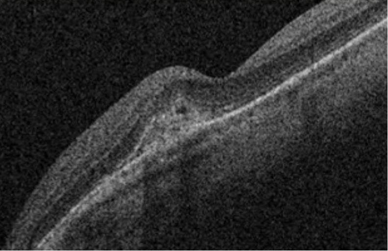 Peripheral myopic degenerations and myopic choroidal neovascularisation ...