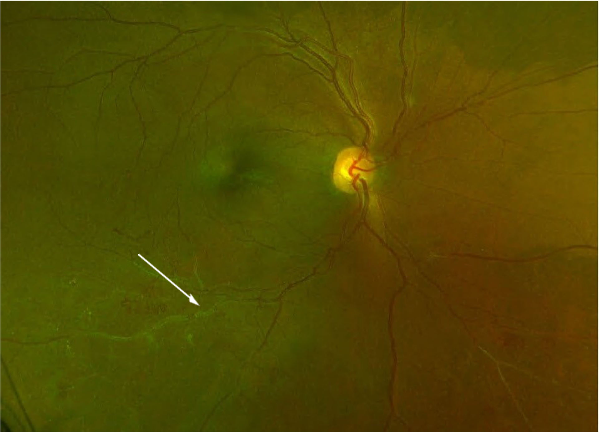Retinal vein occlusion | Viewpoint
