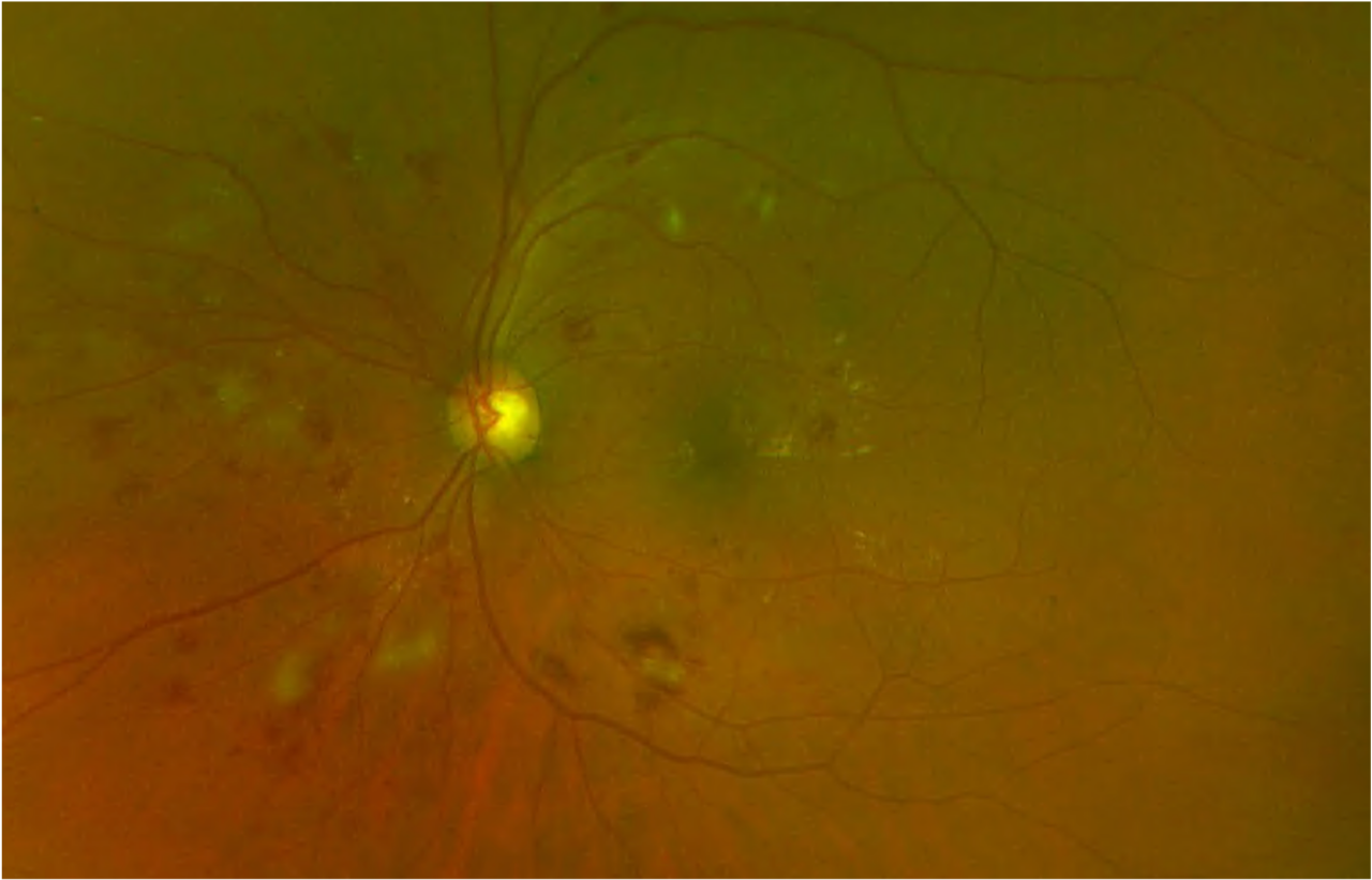 Hypertensive retinopathy | Viewpoint
