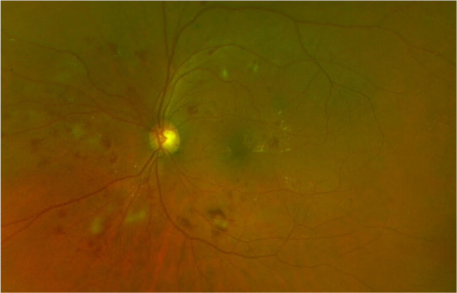 Hypertensive retinopathy | Viewpoint
