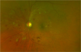 Hypertensive retinopathy | Viewpoint