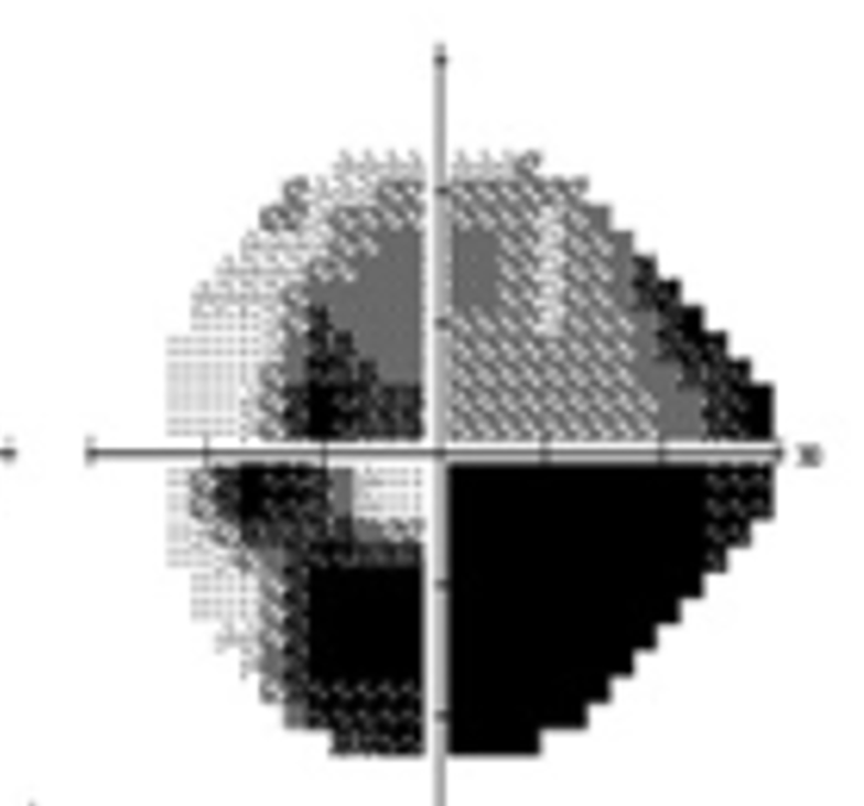 Primary and secondary open-angle glaucoma | Viewpoint