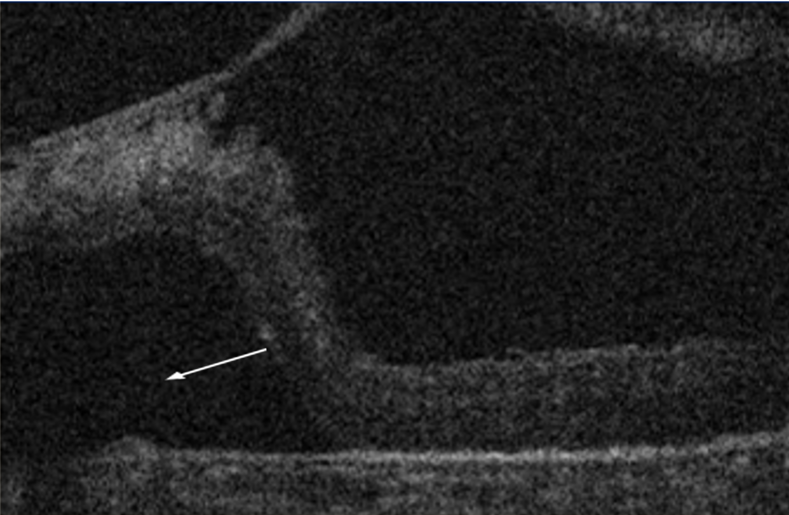 Tractional and exudative retinal detachment | Viewpoint