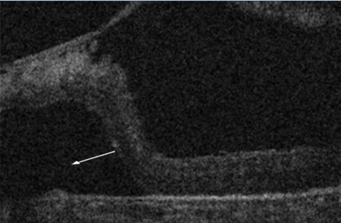 Tractional and exudative retinal detachment | Viewpoint