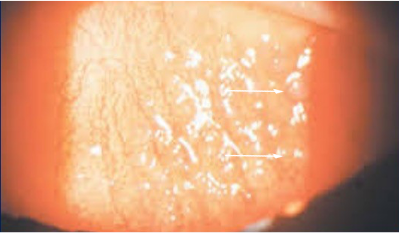 Contact lens complications | Viewpoint