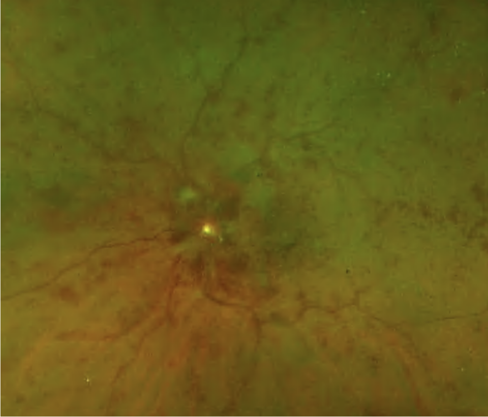 Neovascular glaucoma | Viewpoint