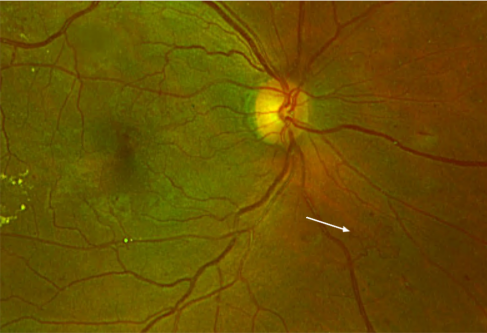 Diabetic retinopathy | Viewpoint