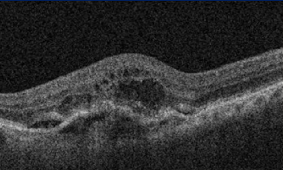 Neovascular age-related macular degeneration | Viewpoint