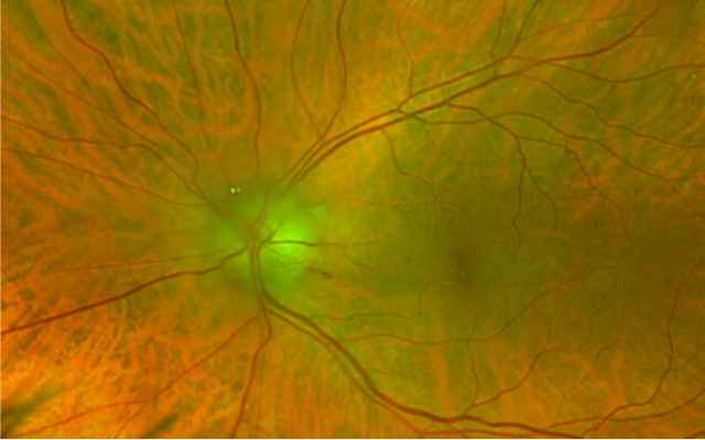 Papilloedema and optic disc swelling | Viewpoint