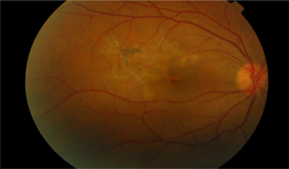Posterior uveitis and panuveitis | Viewpoint