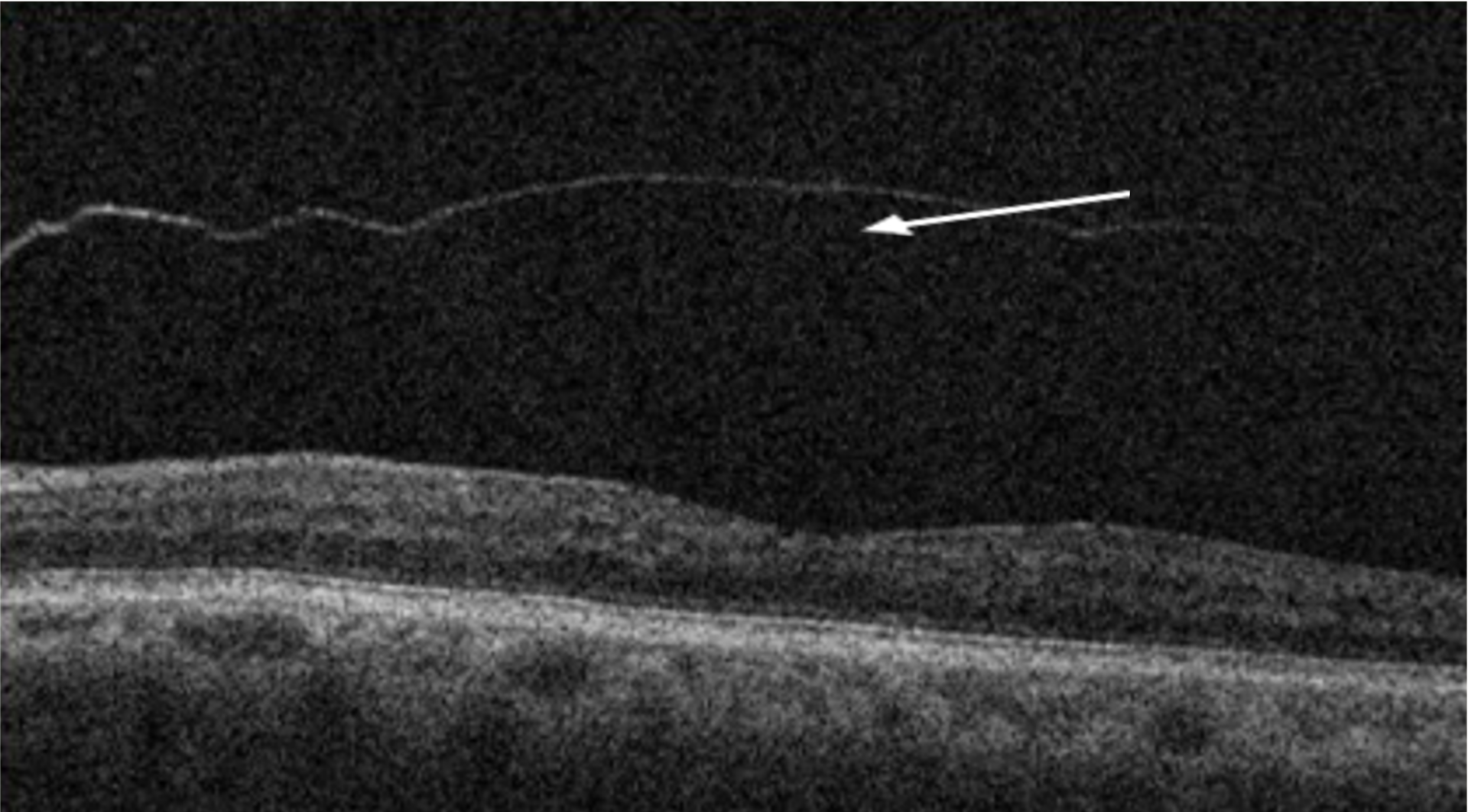 Posterior vitreous detachment | Viewpoint