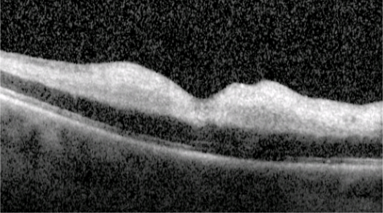 Retinal artery occlusion | Viewpoint