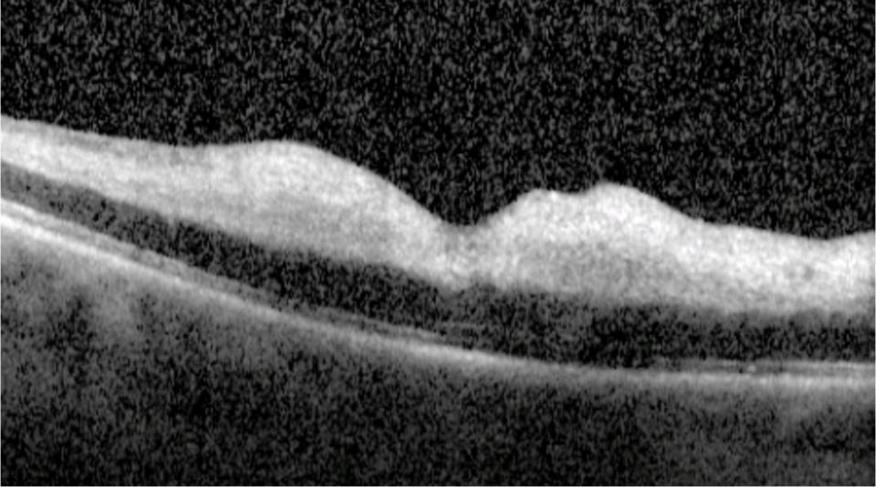 Retinal artery occlusion | Viewpoint