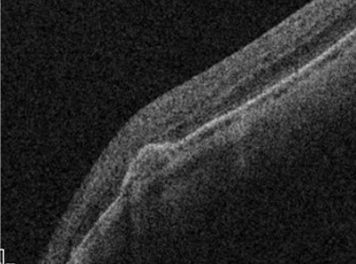 Peripheral myopic degenerations and myopic choroidal neovascularisation ...