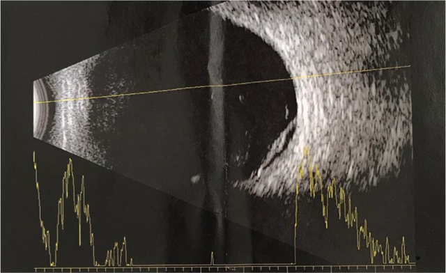 Rhegmatogenous retinal detachment | Viewpoint