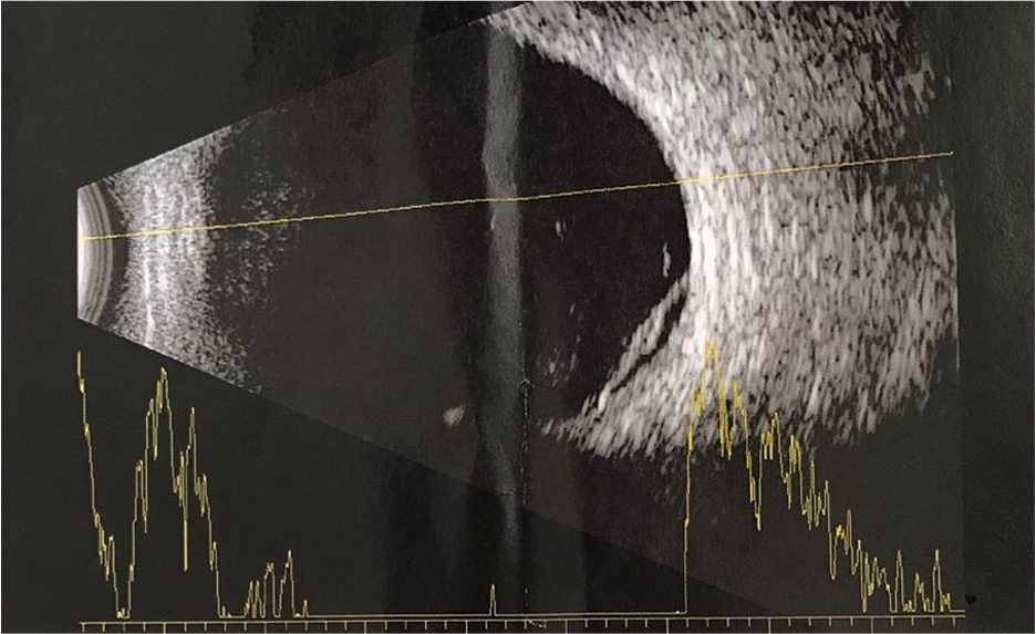 Rhegmatogenous retinal detachment | Viewpoint
