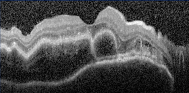 Tractional and exudative retinal detachment | Viewpoint