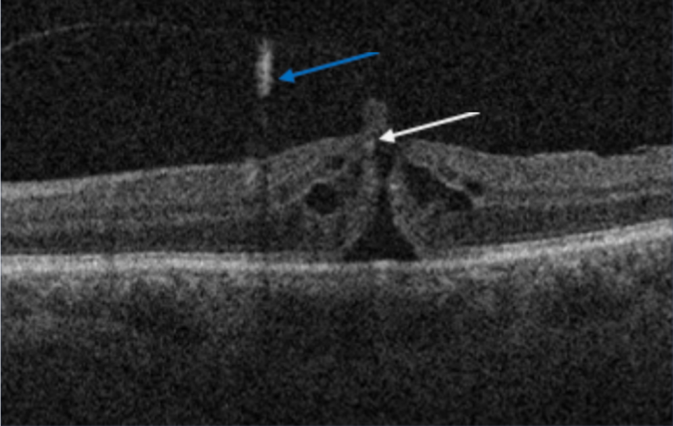 Vitreoretinal surface diseases | Viewpoint