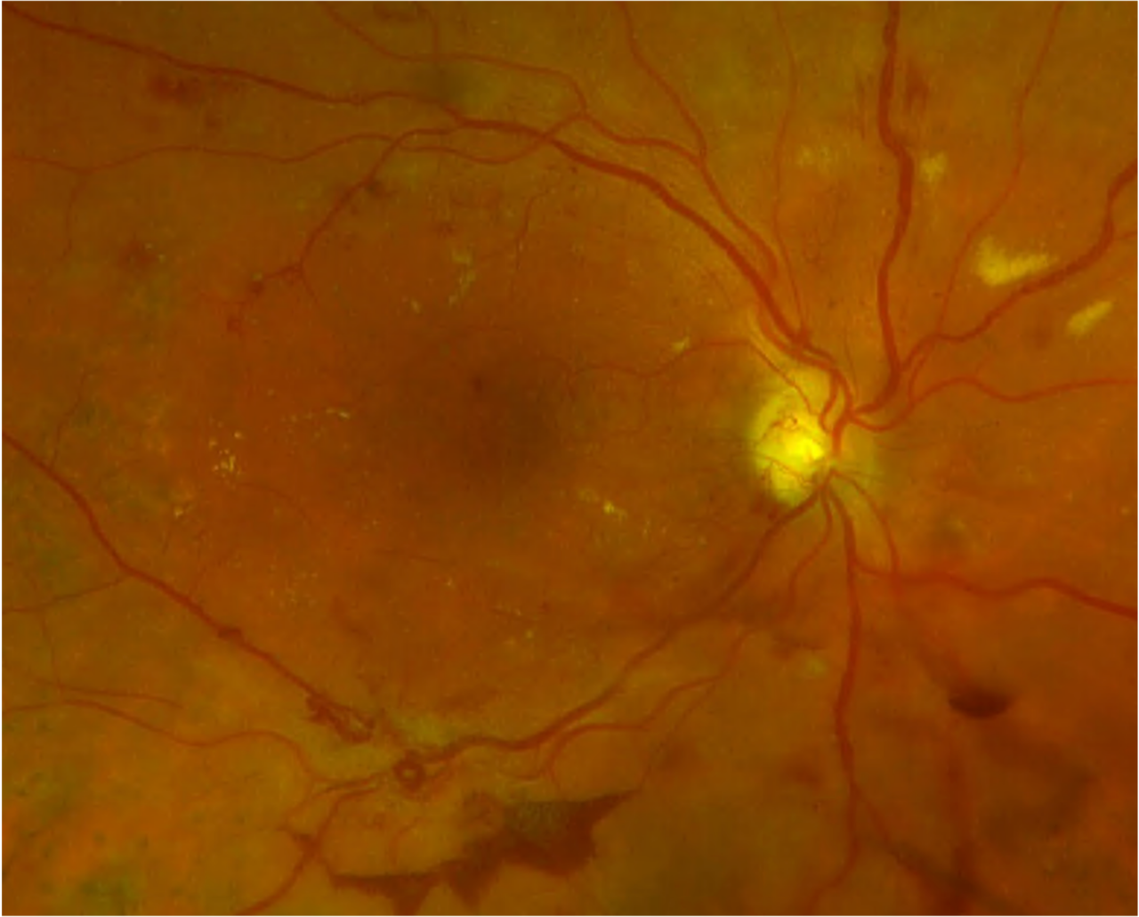 Diabetic retinopathy | Viewpoint
