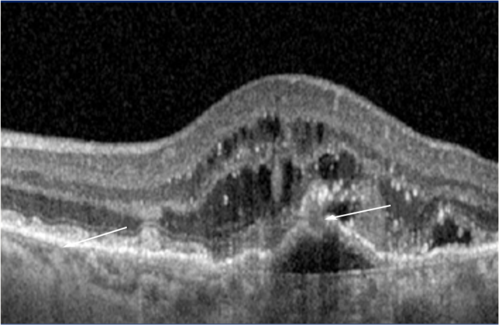 Neovascular age-related macular degeneration | Viewpoint
