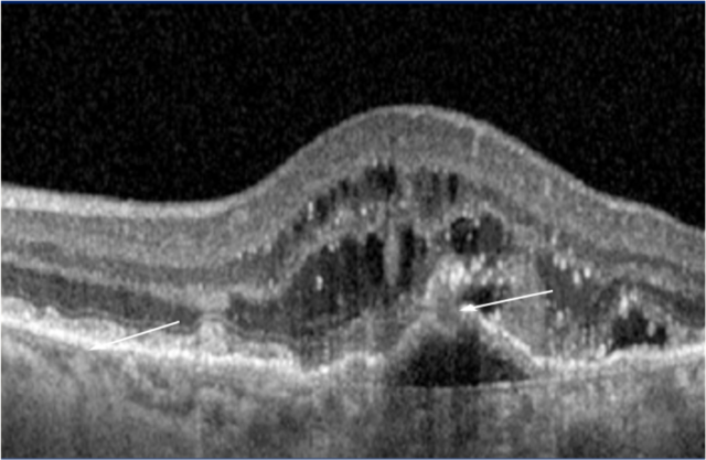 Neovascular age-related macular degeneration | Viewpoint