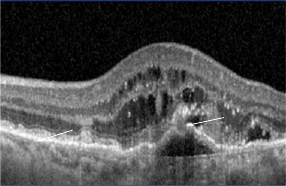 Neovascular age-related macular degeneration | Viewpoint