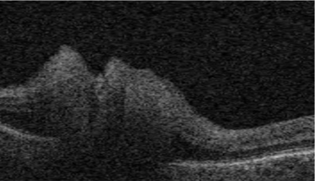 Papilloedema and optic disc swelling | Viewpoint