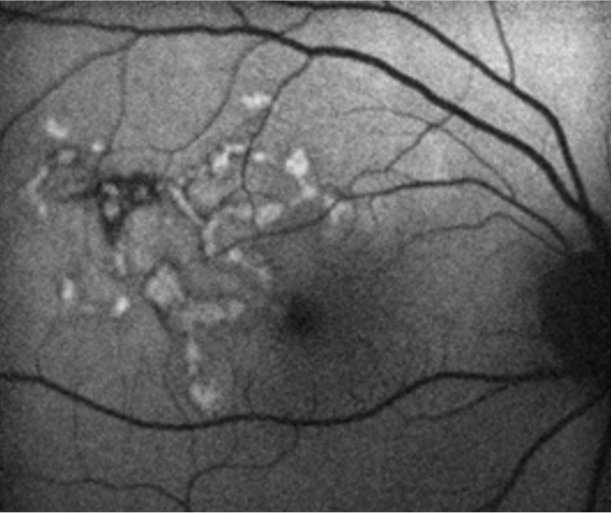 Posterior uveitis and panuveitis | Viewpoint