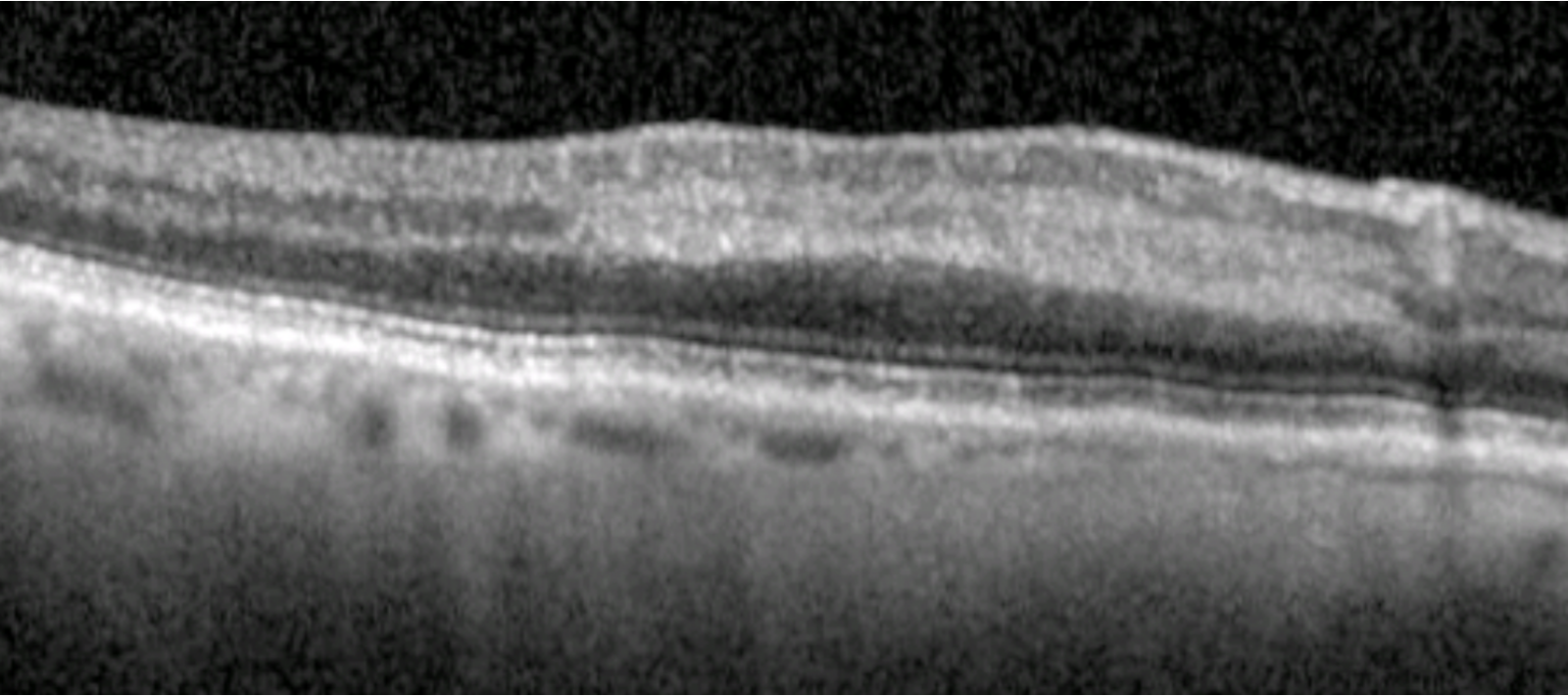Retinal artery occlusion | Viewpoint