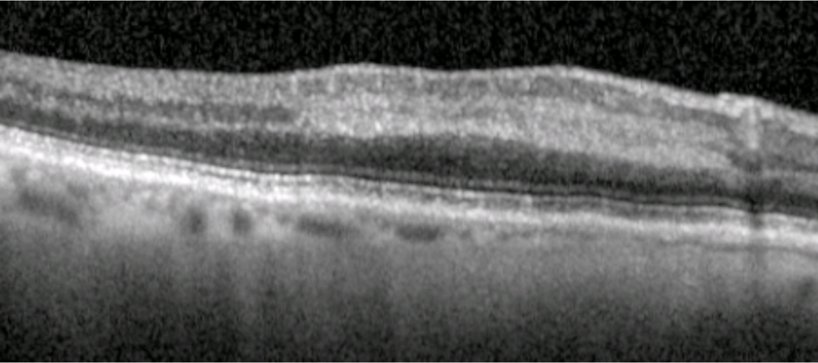 Retinal artery occlusion | Viewpoint