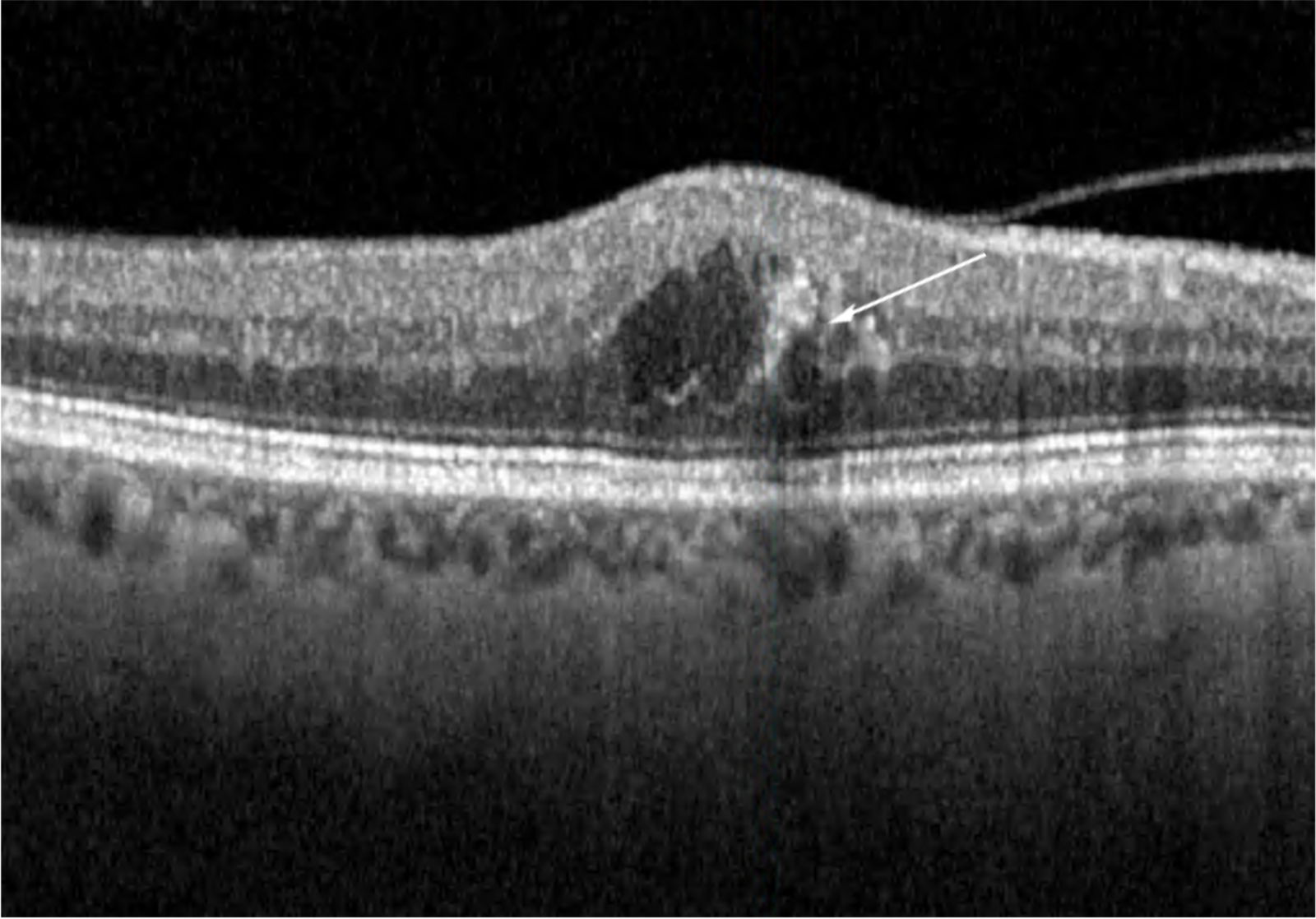 Retinal vein occlusion | Viewpoint
