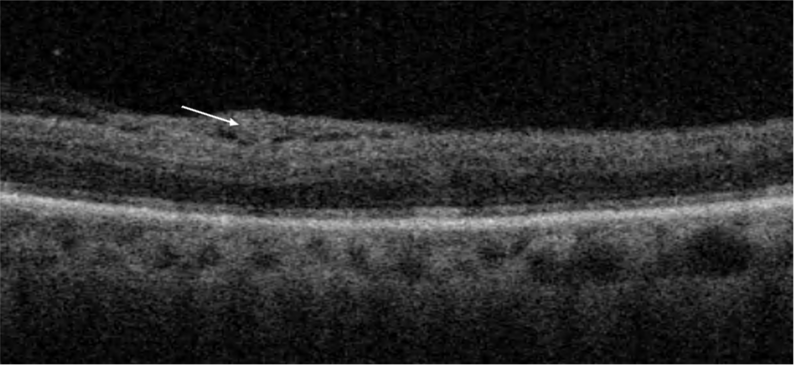 Diabetic retinopathy | Viewpoint