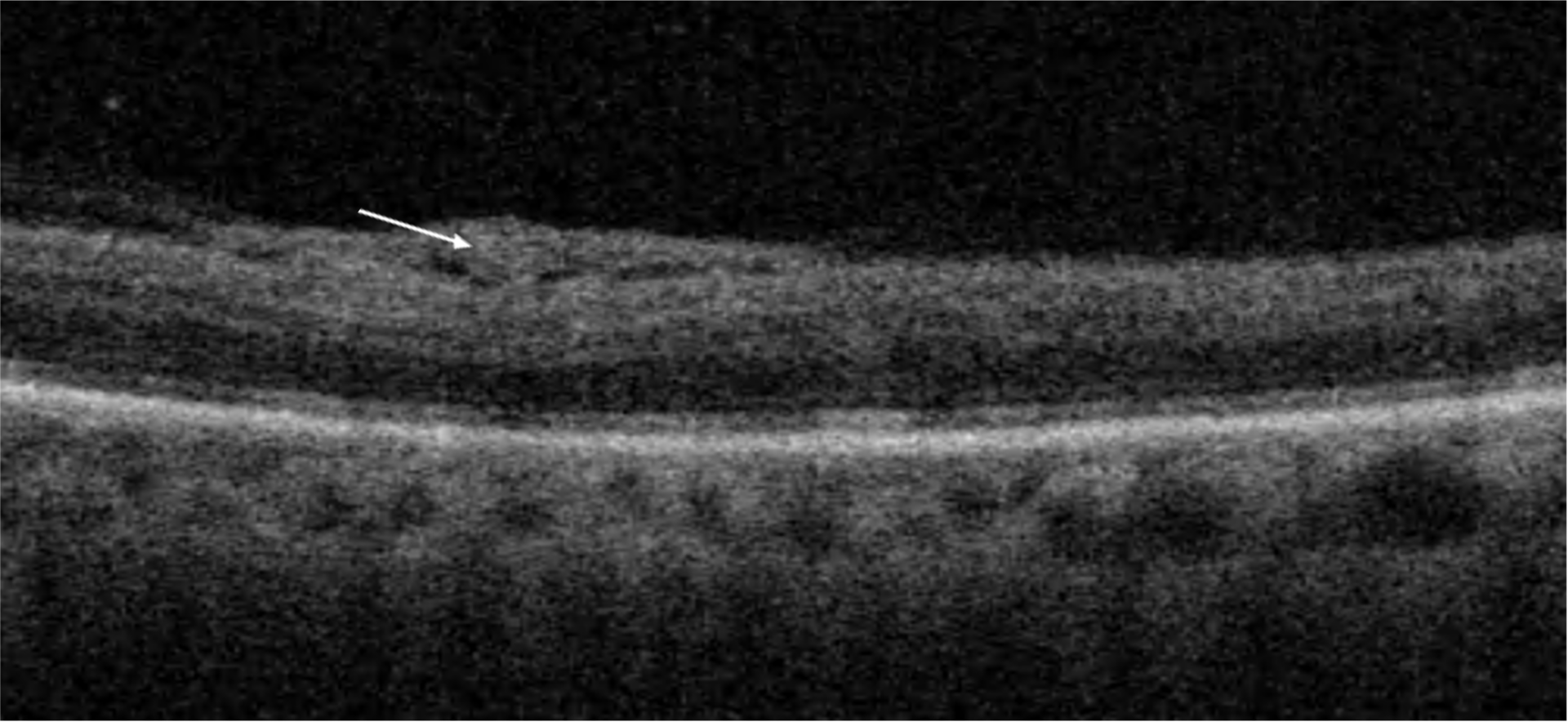 Diabetic retinopathy | Viewpoint