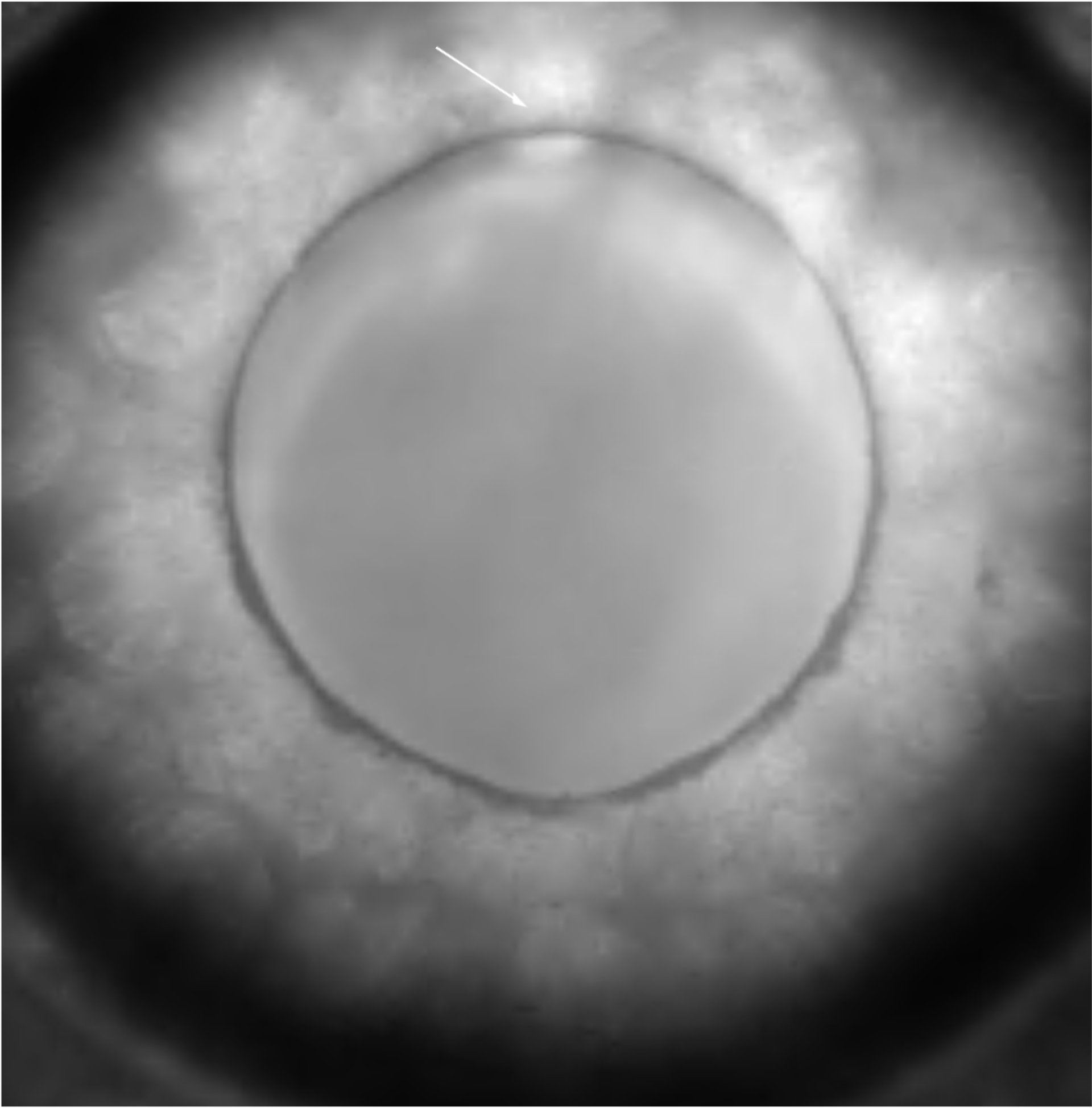 Neovascular glaucoma | Viewpoint