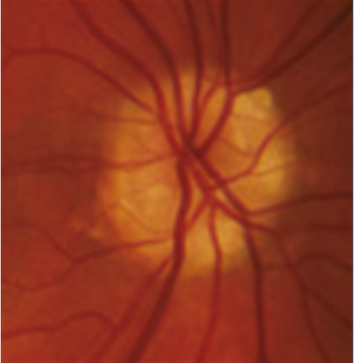 Optic disc drusen | Viewpoint