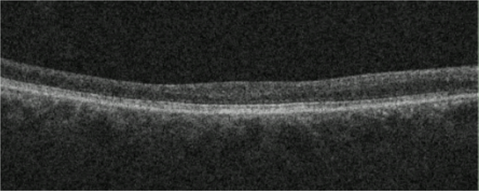 Retinal artery occlusion | Viewpoint