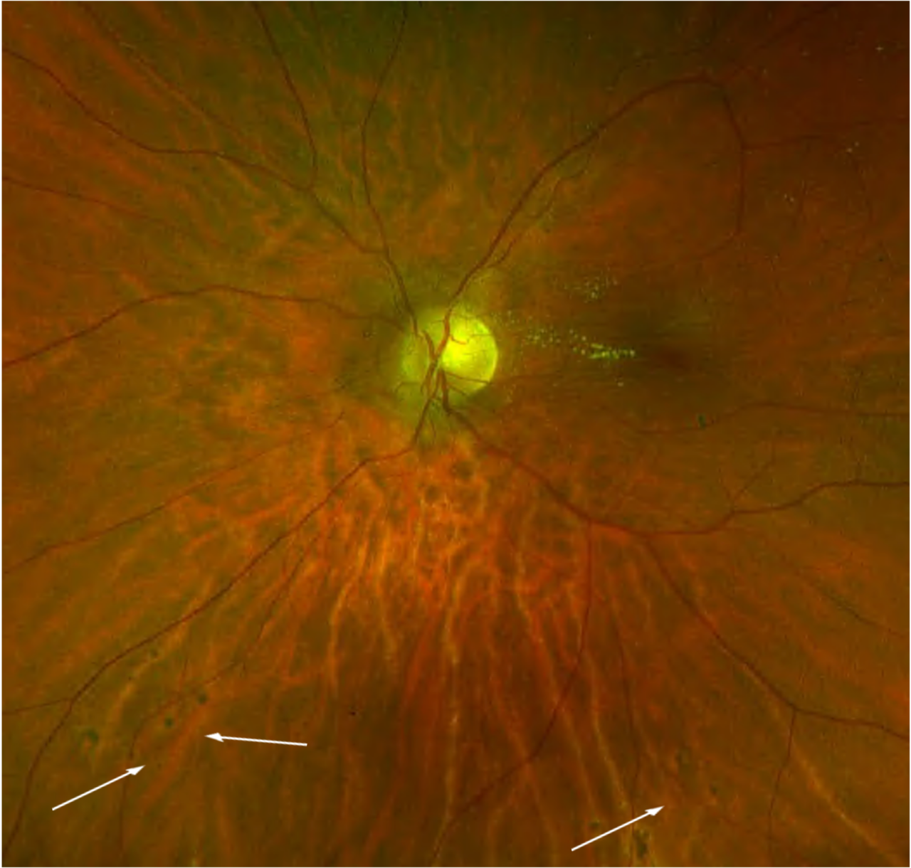 Hypertensive retinopathy | Viewpoint
