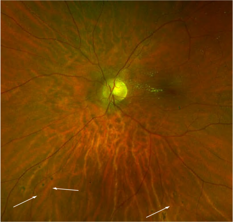 Hypertensive retinopathy | Viewpoint