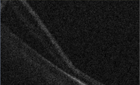 Rhegmatogenous retinal detachment | Viewpoint