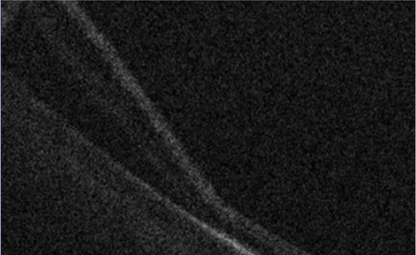 Rhegmatogenous Retinal Detachment B Scan