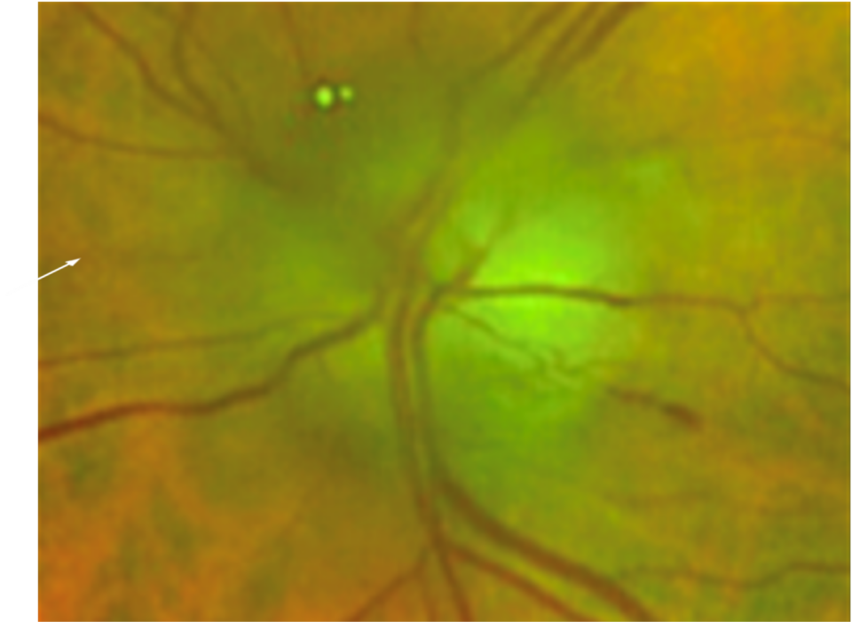 Optic disc drusen | Viewpoint