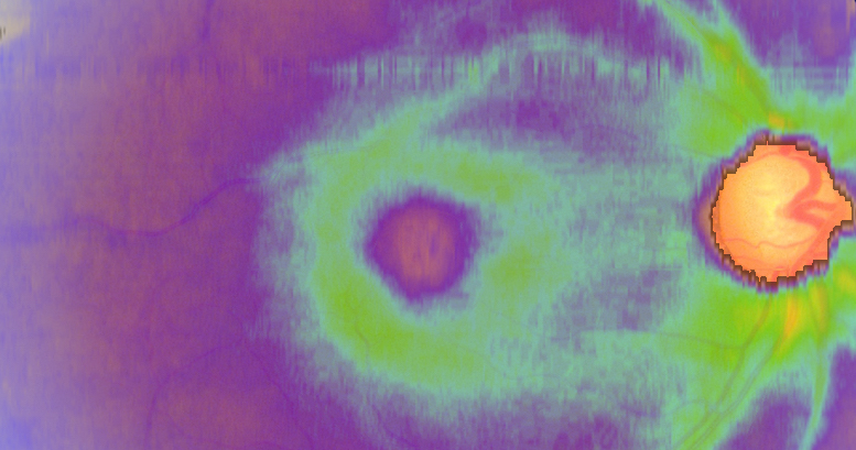 Primary and secondary open-angle glaucoma | Viewpoint Primary and secondary open-angle glaucoma | Viewpoint